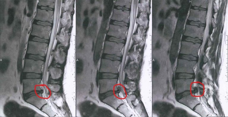 Hernie discale L5S1, symptômes, traitement, opération et récupération - Monsieur Vizir